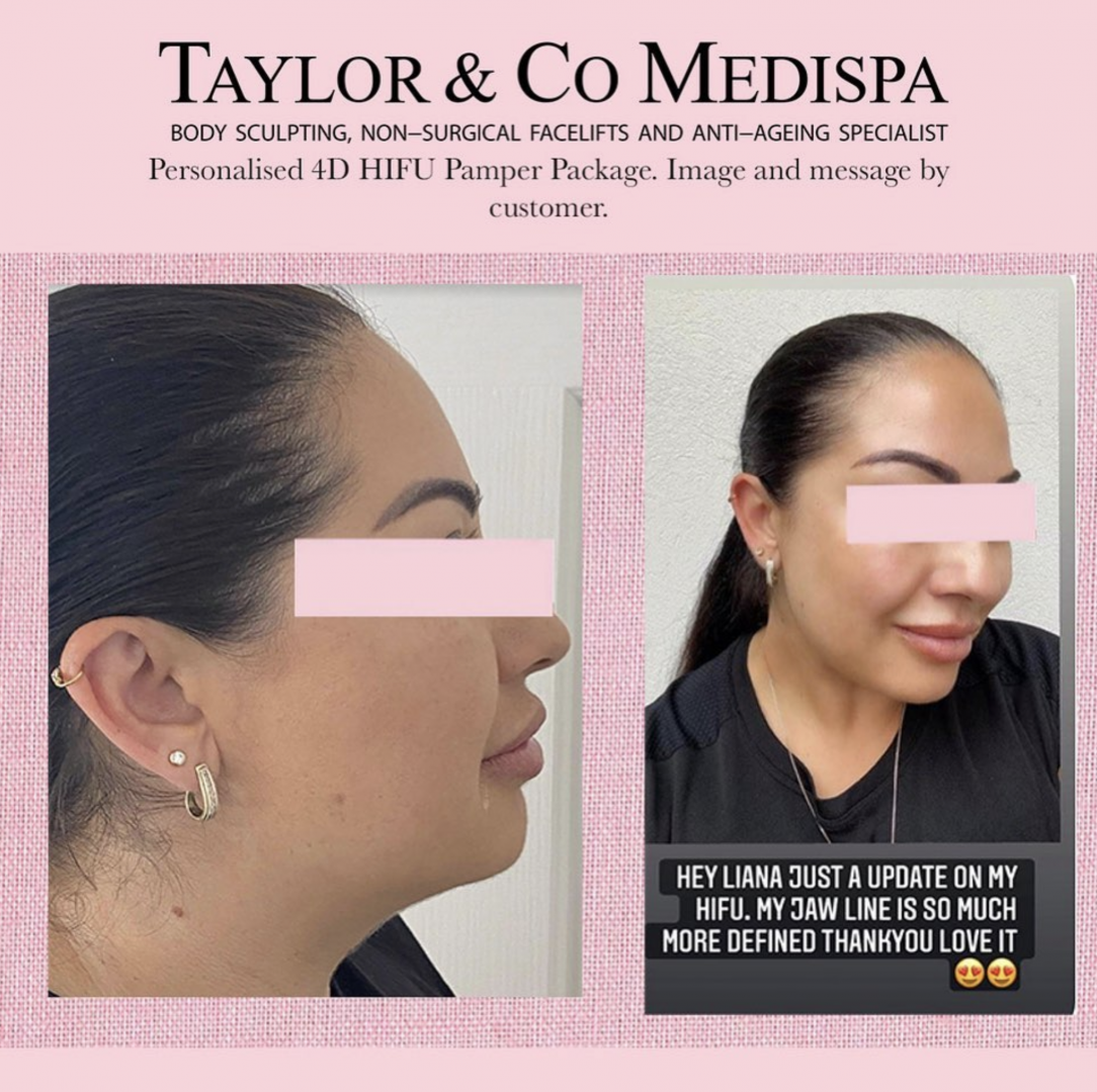 HIFU Non Surgical BEFORE & AFTERS - Taylor & Co Medispa